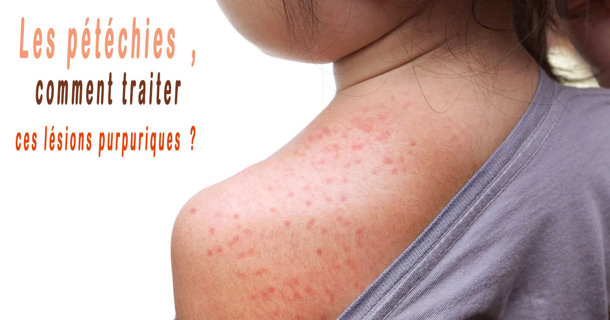 Les pétéchies, comment traiter ces lésions purpuriques