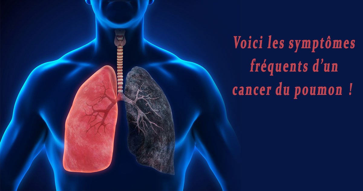 Voici les symptômes fréquents d’un cancer du poumon